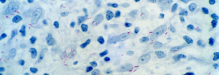 Leprosy in 2018: an ancient disease that remains a public health problem