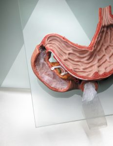 What is the EndoBarrier and how does it help type 2 diabetes?