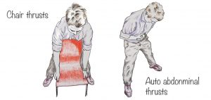 What is the Is the Heimlich Manoeuvre and is it time to update it?
