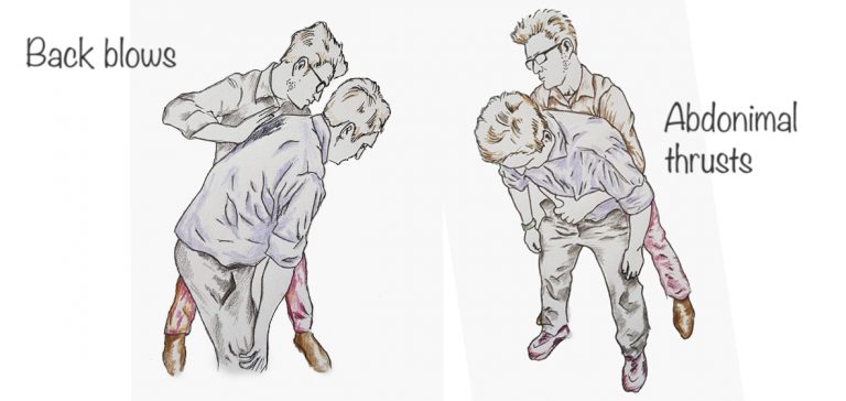 What is the Is the Heimlich Manoeuvre and is it time to update it?